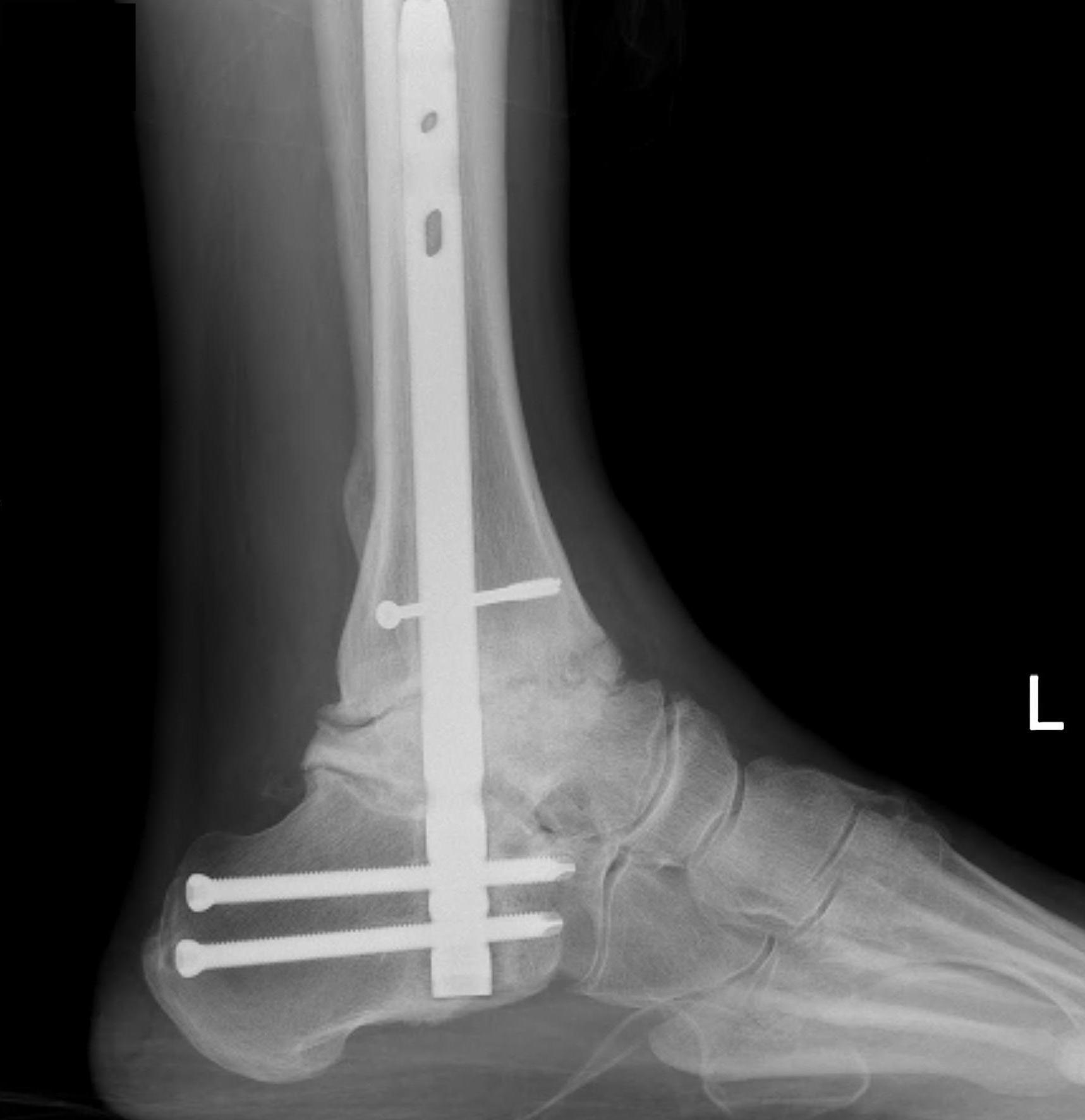 Talar neck complications | The Bone School